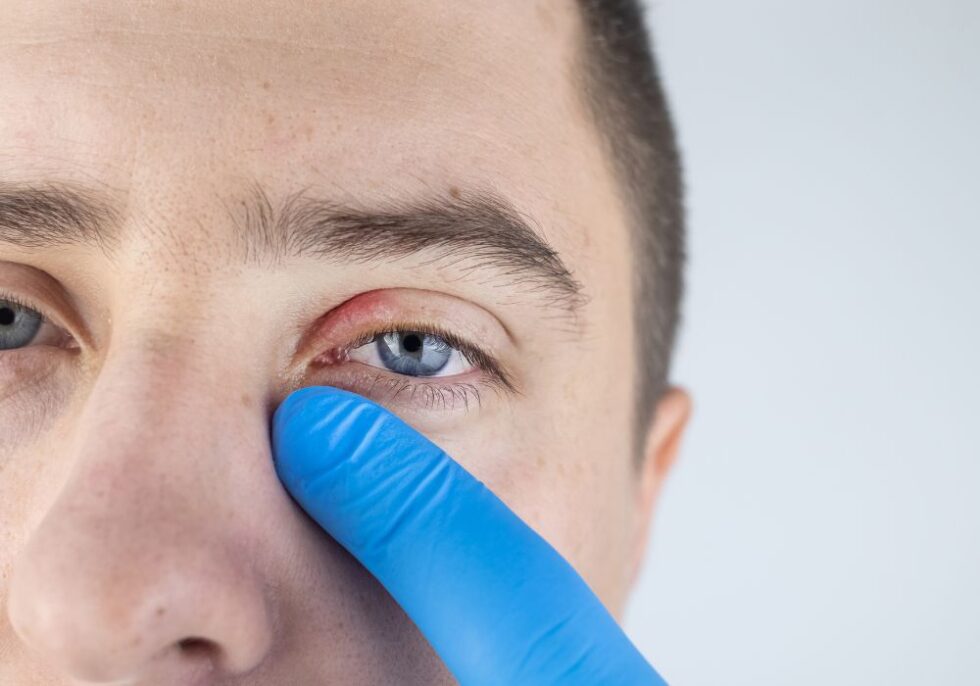 De oorzaak en behandeling van Blefaritis - Optiekvision B.V.